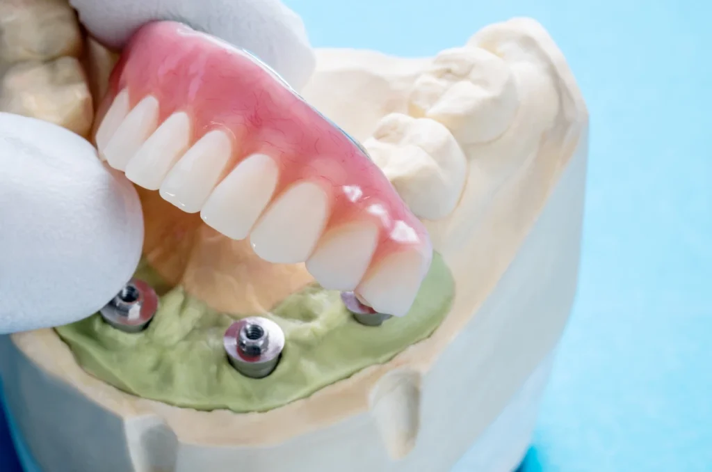 Prótese Protocolo Em São Vicente: Seu Sorriso Renovado