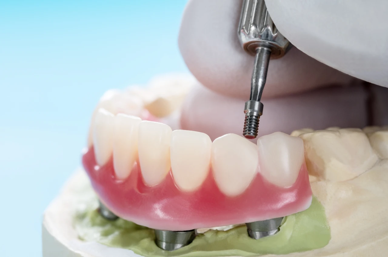 Prótese Protocolo Em São Vicente: Seu Sorriso Renovado